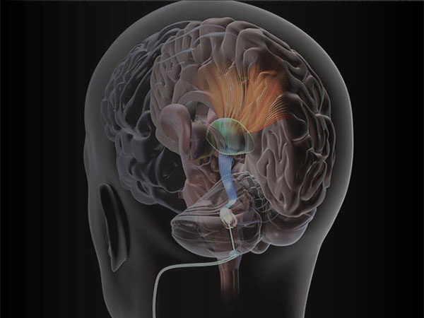 Cleveland Clinic Neurological Institute