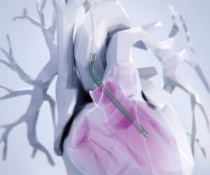 Ventricular Tachycardia Treatment Guide | Cleveland Clinic